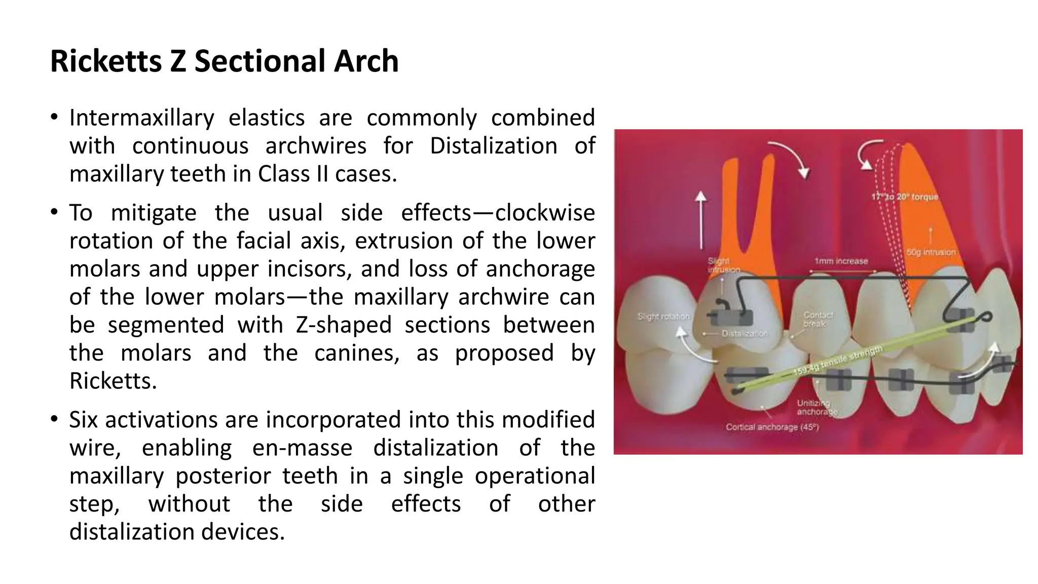 Effects of the Ricketts Z Sectional Arch in Producing En Masse ...