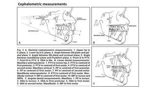 Effects of the Ricketts Z Sectional Arch in Producing En Masse ...