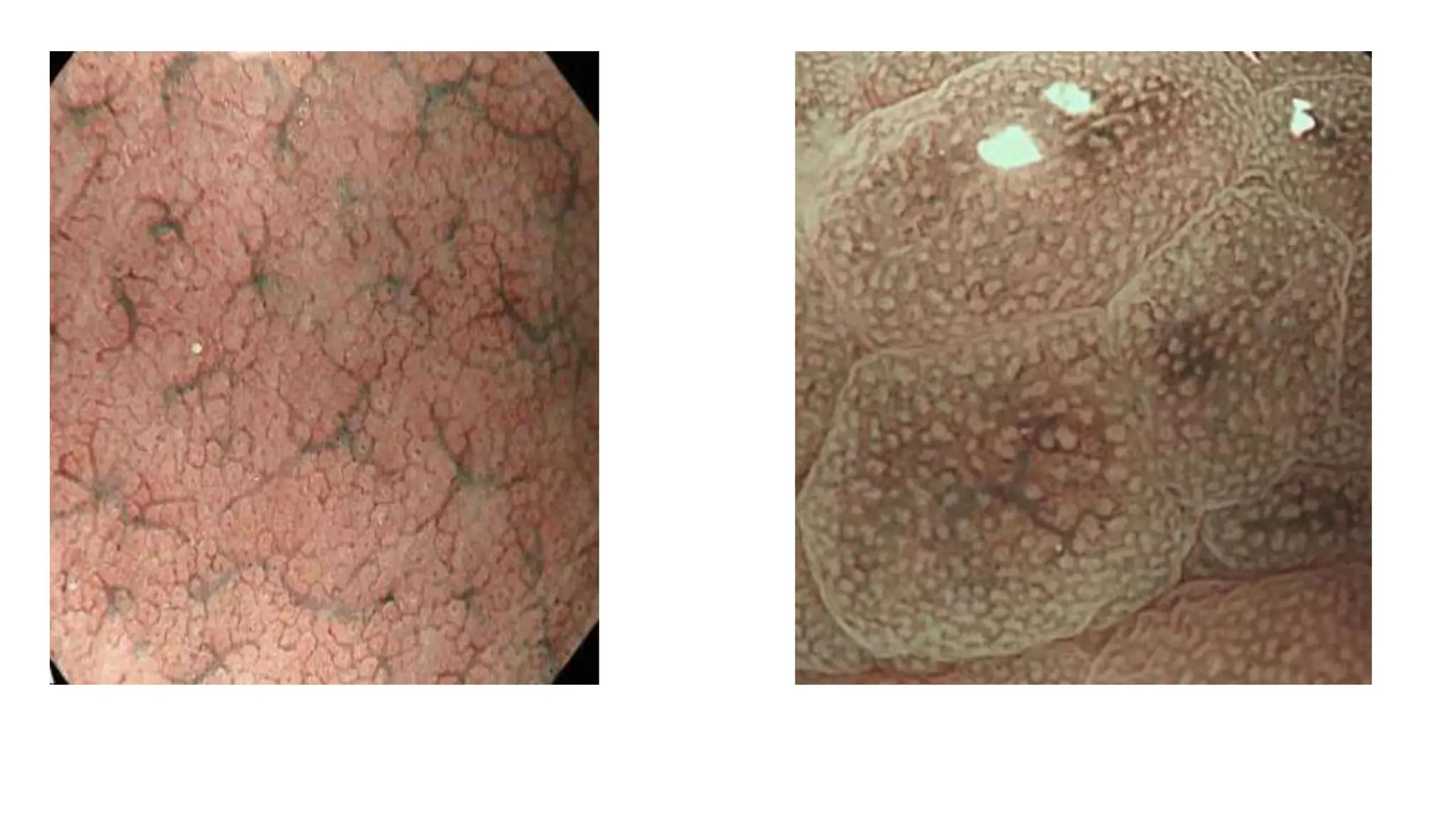 “Efficacy and feasibility of Narrow Band Imaging Endoscopy for ...
