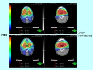 Efficacy Of Imrt Through Dmlc And Inverse Planning | PPT