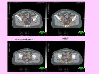 Efficacy Of Imrt Through Dmlc And Inverse Planning | PPT