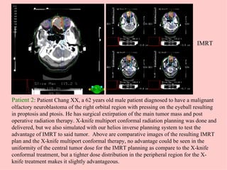 Efficacy Of Imrt Through Dmlc And Inverse Planning | PPT