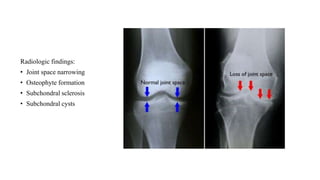 Efficacy of knee orthosis and foot orthosis in knee osteoarthritis | PPTX