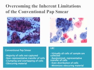 Efficacy of liquid based cytology versus conventional smears | PPTX