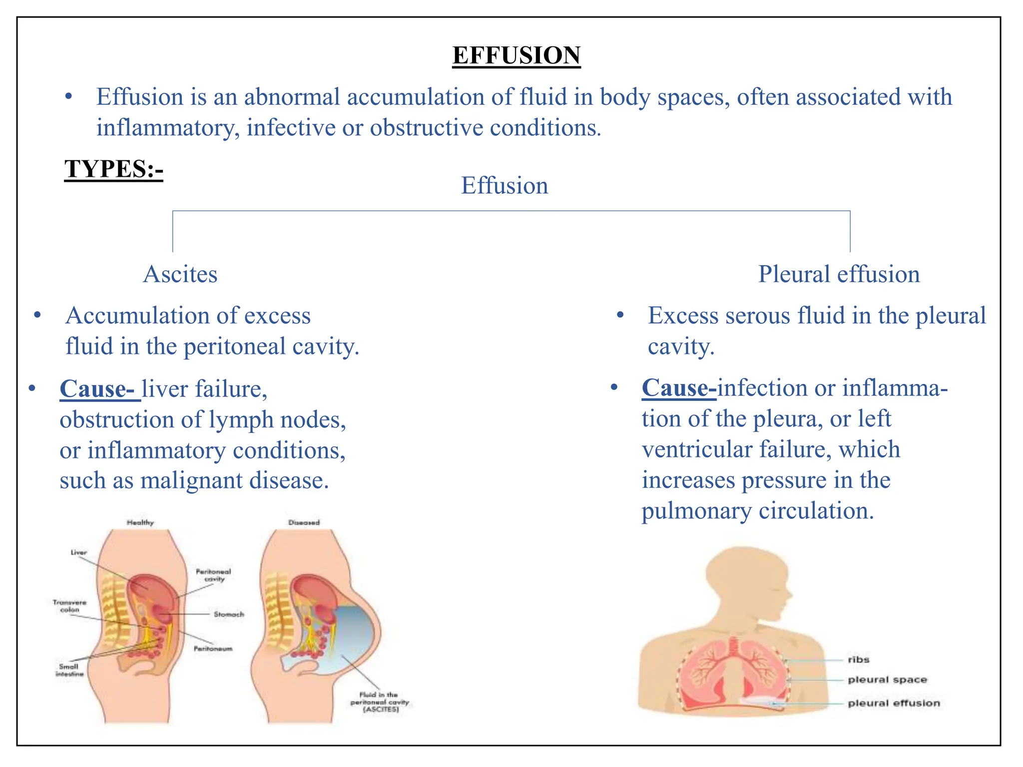 Effusion (Ascites, Pleural Effusion); Human Anatomy And Physiology ...