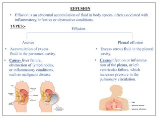 Effusion (Ascites, Pleural Effusion); Human Anatomy And Physiology ...