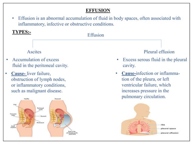 Effusion (Ascites, Pleural Effusion); Human Anatomy And Physiology ...