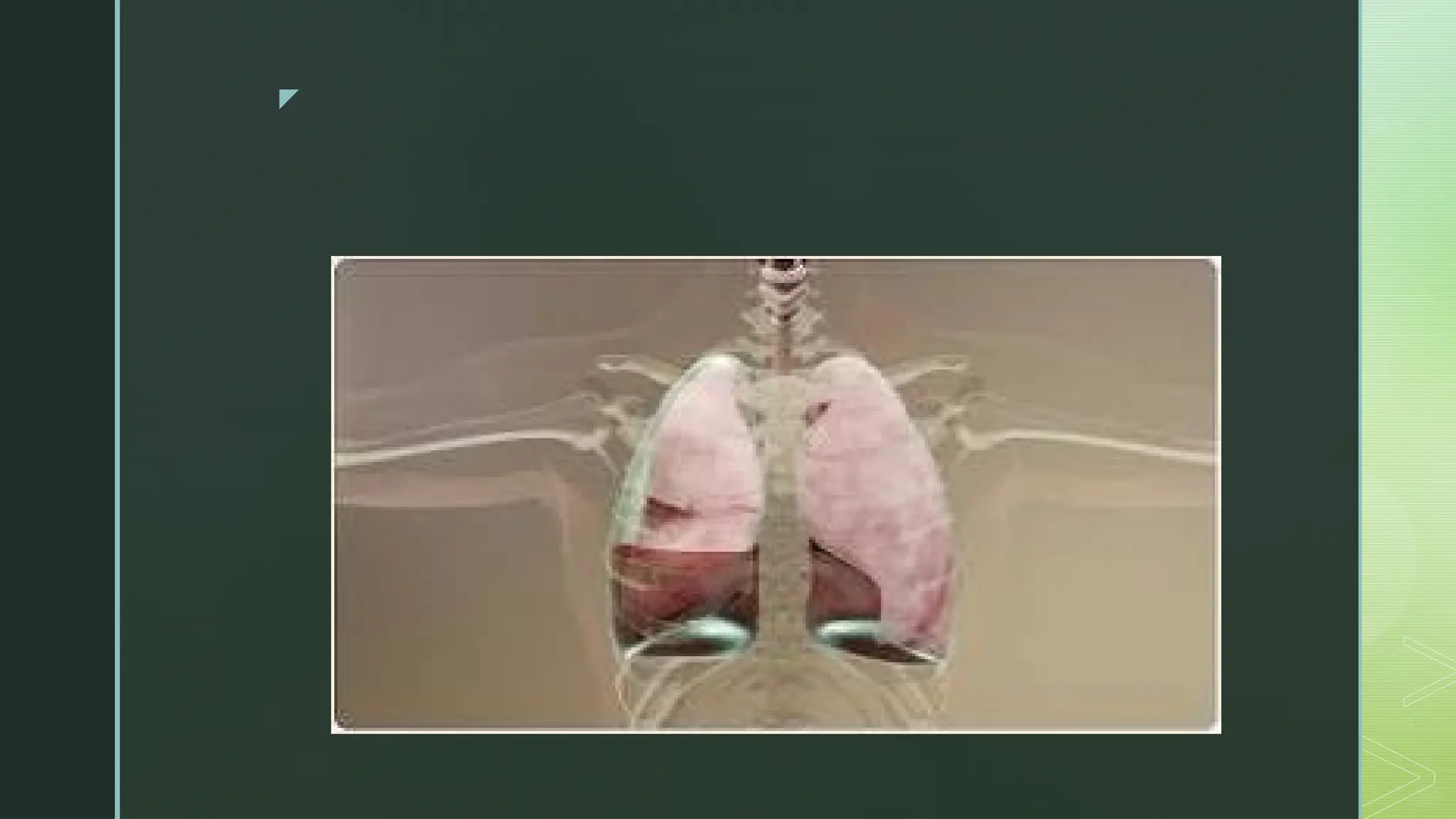 Pleural effusion types and management.pptx