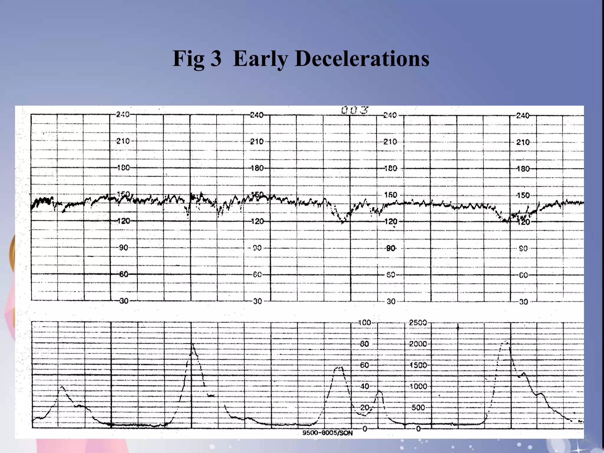 EFM- Electerical Fetal Monitoring- Legal issues,Problems,Facts, define, Indication,Basic ...