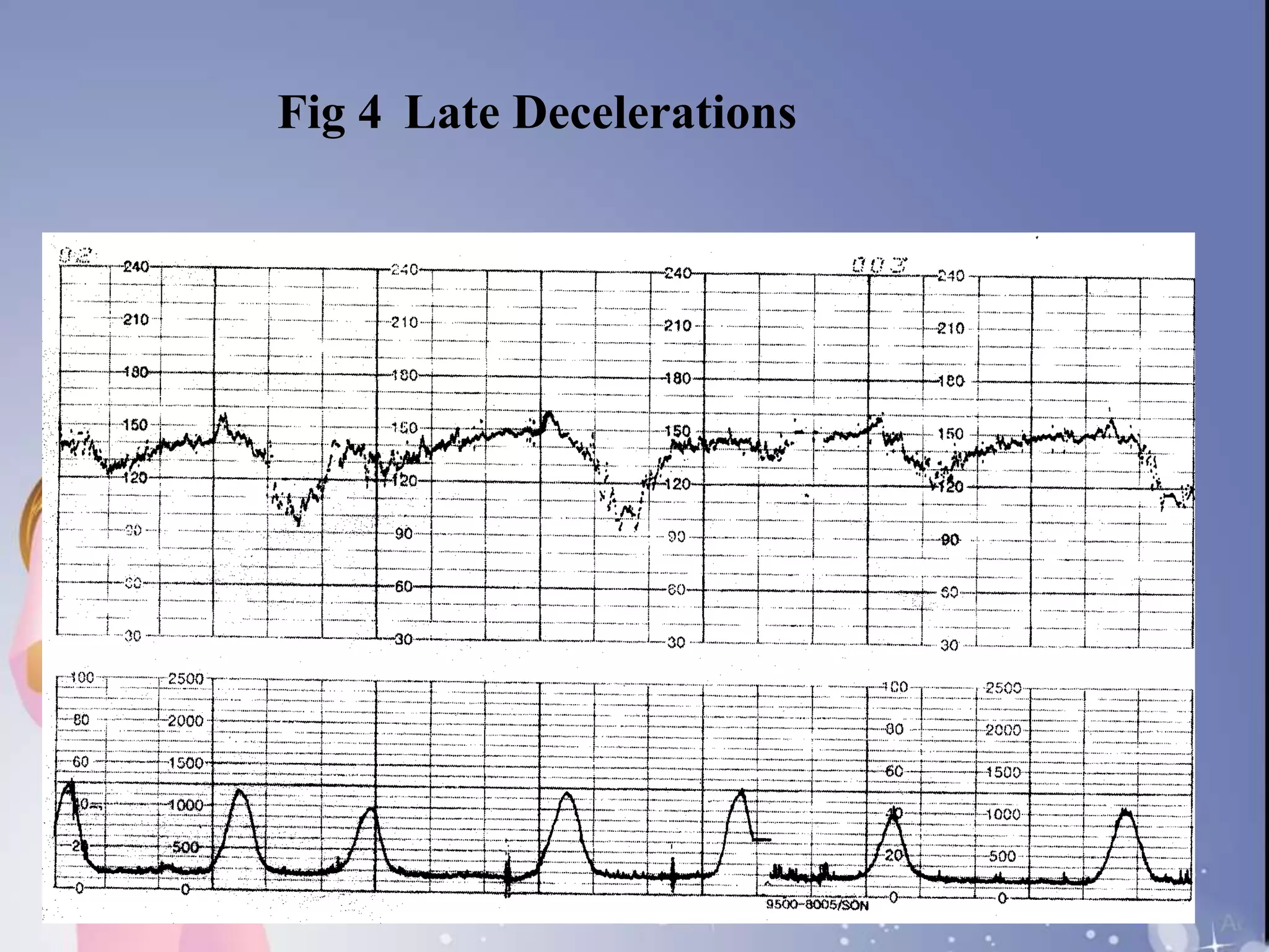 EFM- Electerical Fetal Monitoring- Legal issues,Problems,Facts, define ...
