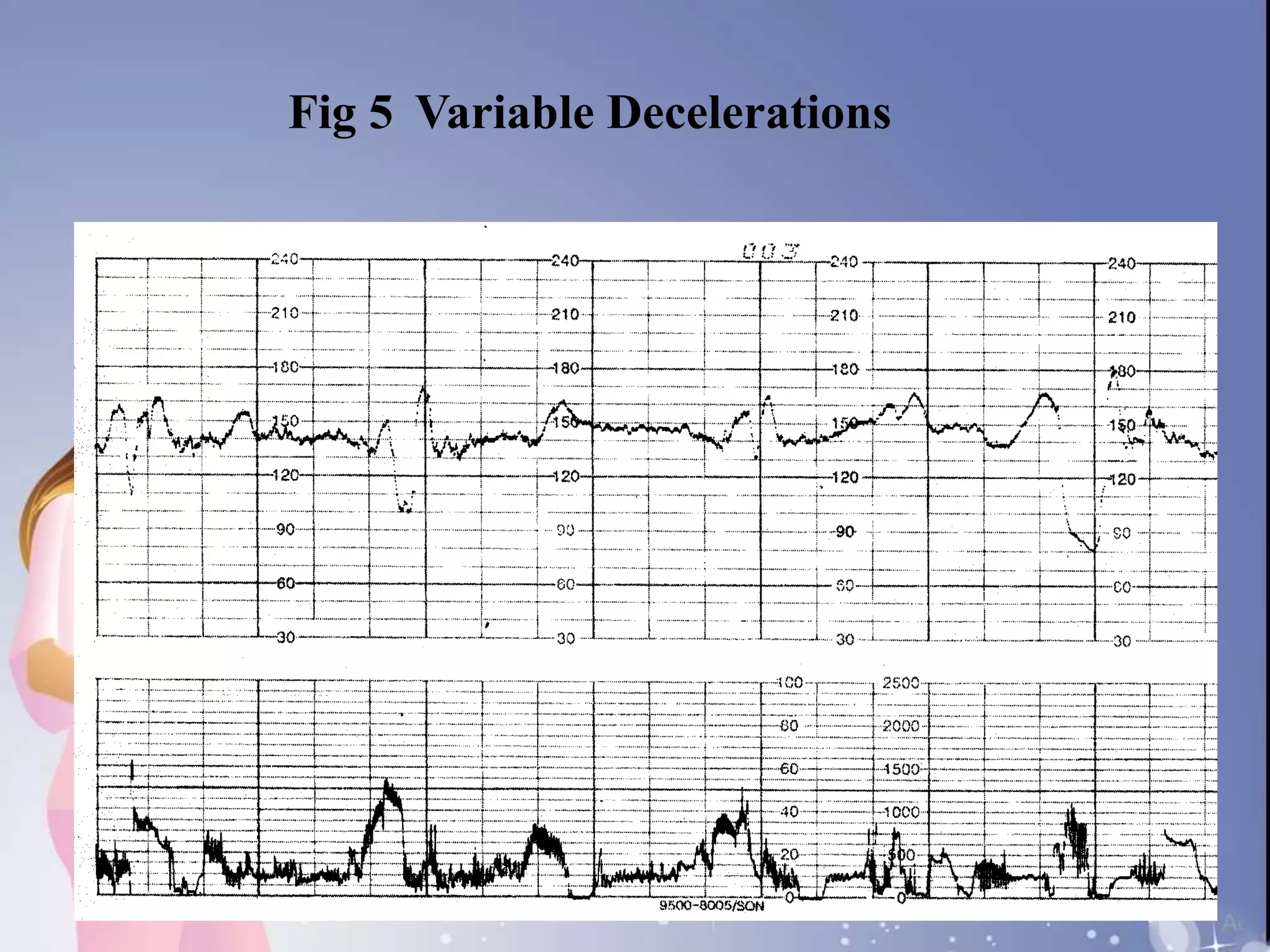 EFM- Electerical Fetal Monitoring- Legal issues,Problems,Facts, define ...
