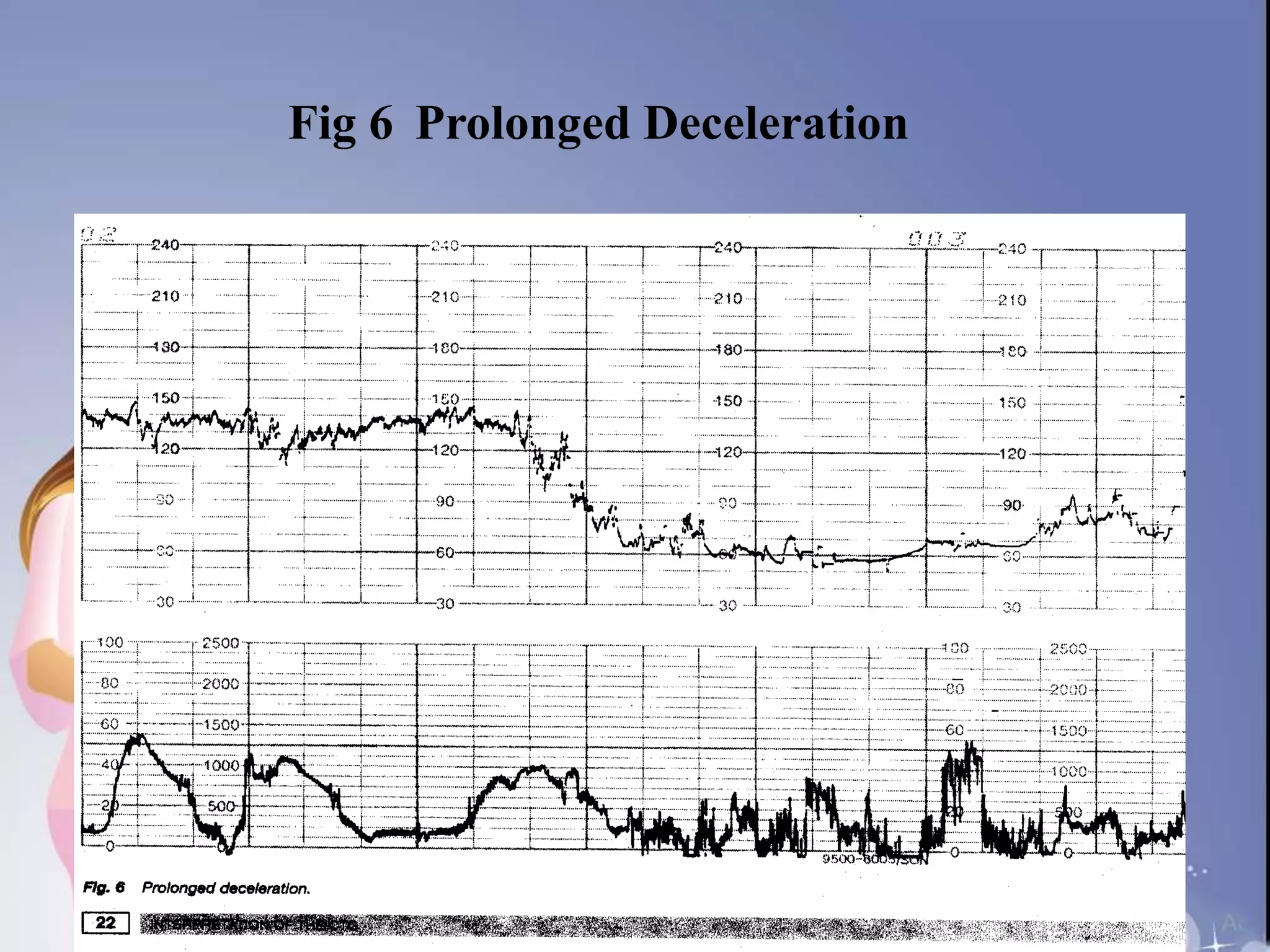 EFM- Electerical Fetal Monitoring- Legal issues,Problems,Facts, define ...