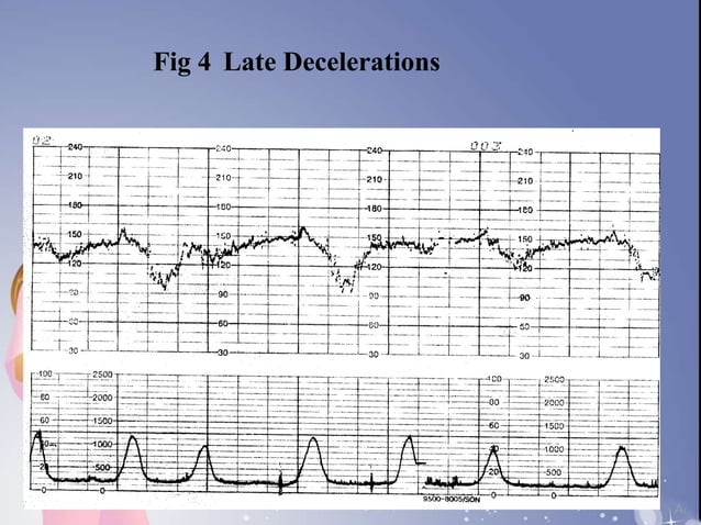 EFM- Electerical Fetal Monitoring- Legal issues,Problems,Facts, define ...