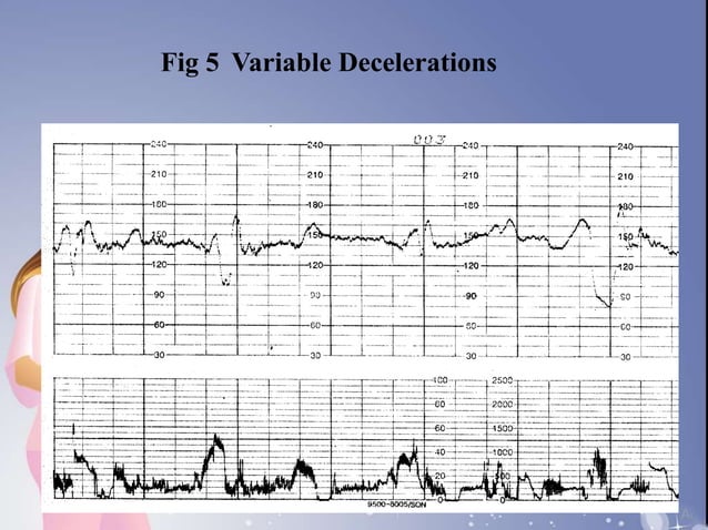 EFM- Electerical Fetal Monitoring- Legal issues,Problems,Facts, define ...
