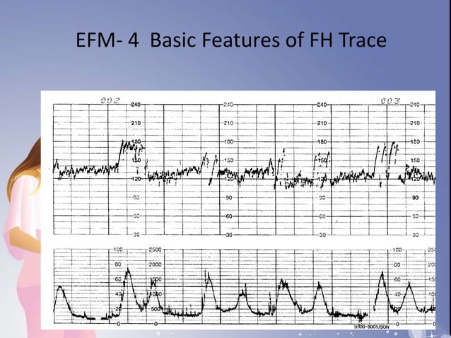 EFM- Electerical Fetal Monitoring- Legal issues,Problems,Facts, define ...