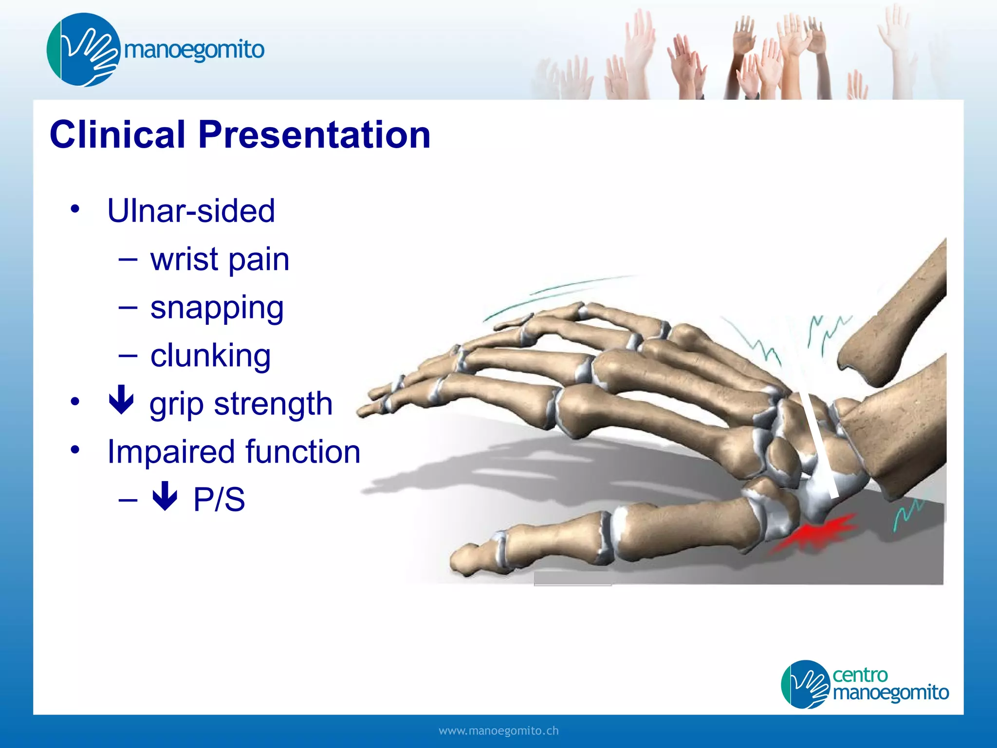 Acute Triangular Fibrocartilage Complex Injuries: Treatment ...