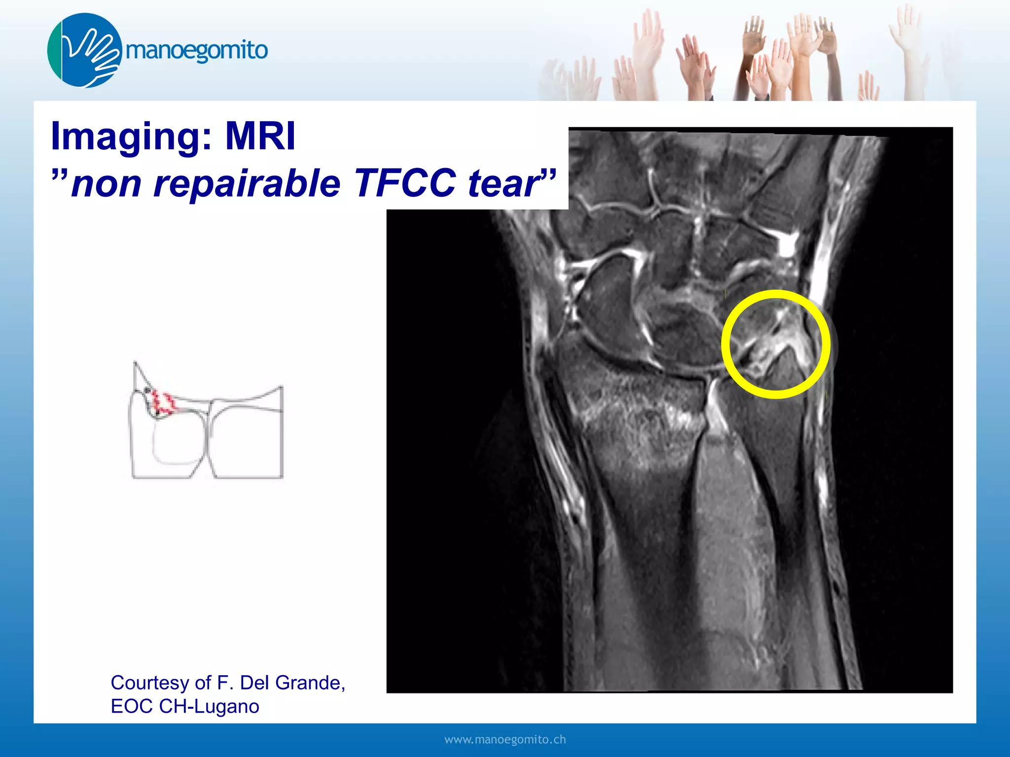 Acute Triangular Fibrocartilage Complex Injuries: Treatment ...