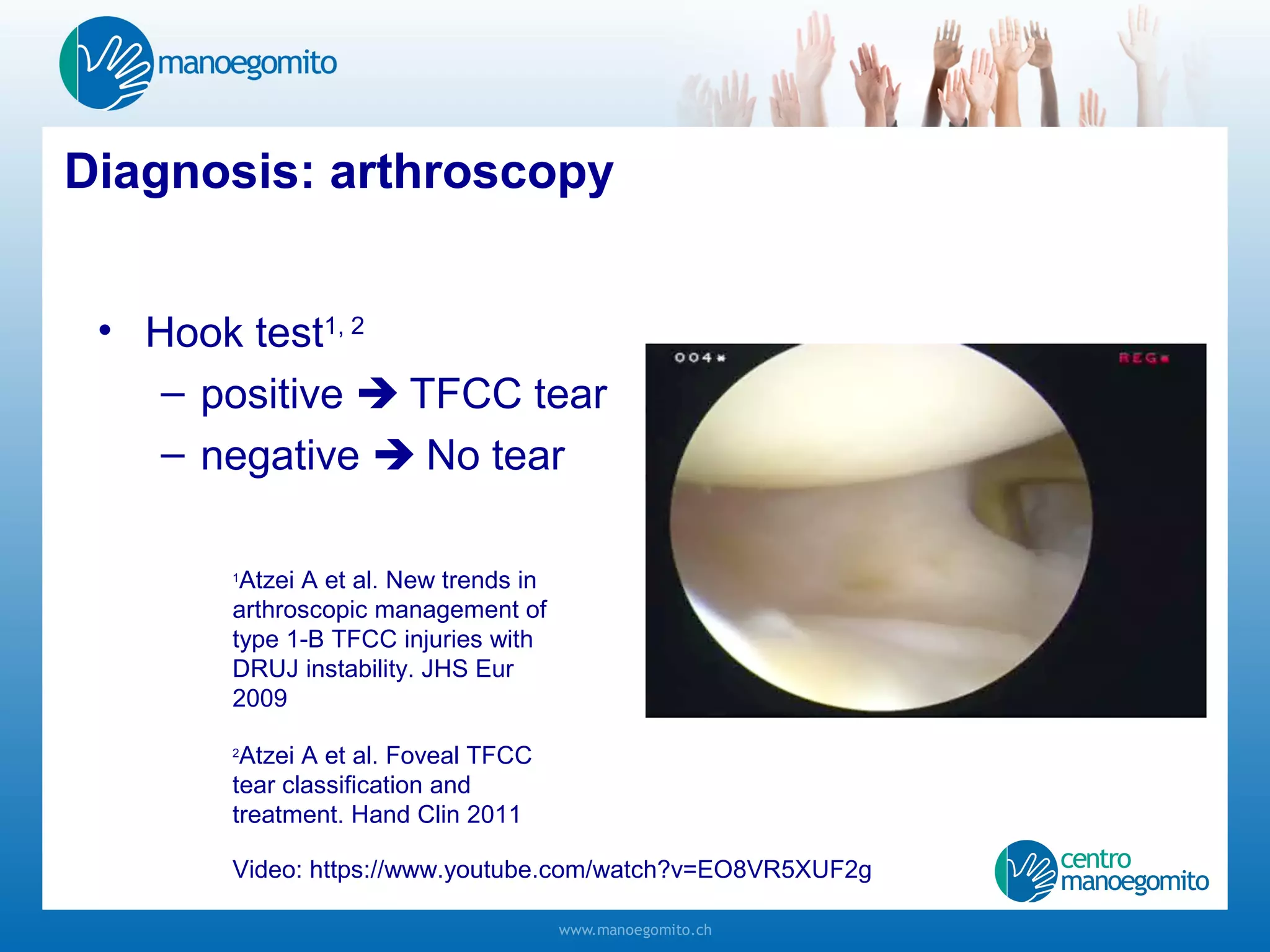 Acute Triangular Fibrocartilage Complex Injuries: Treatment ...