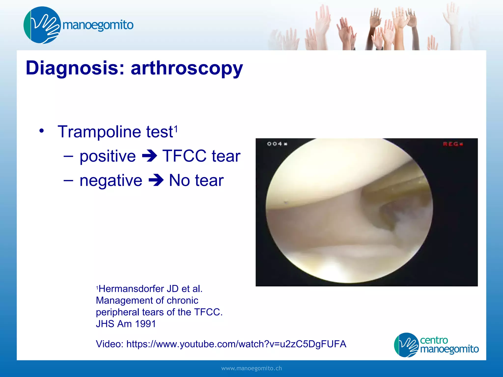 Acute Triangular Fibrocartilage Complex Injuries: Treatment ...