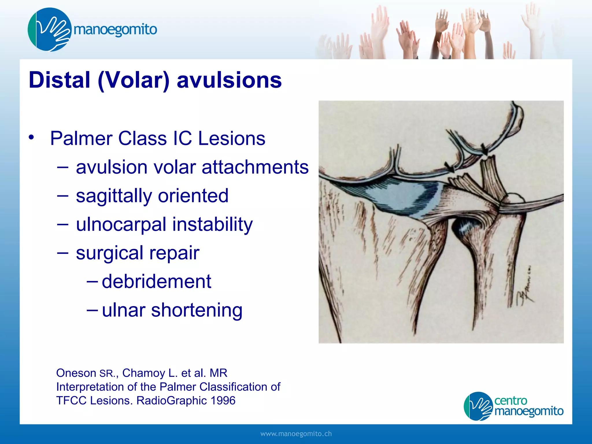 Acute Triangular Fibrocartilage Complex Injuries: Treatment & Management | PPT