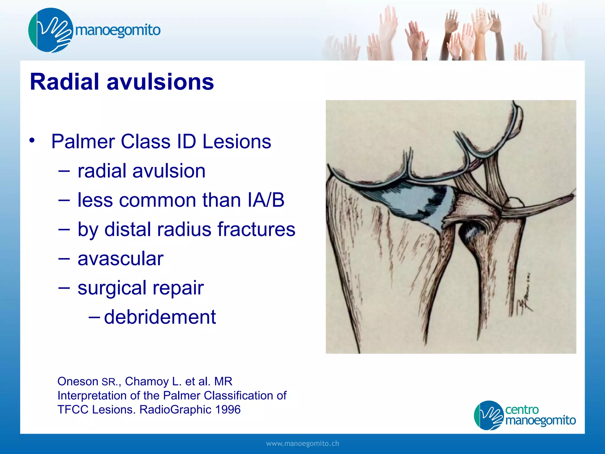 Acute Triangular Fibrocartilage Complex Injuries: Treatment & Management | PPT