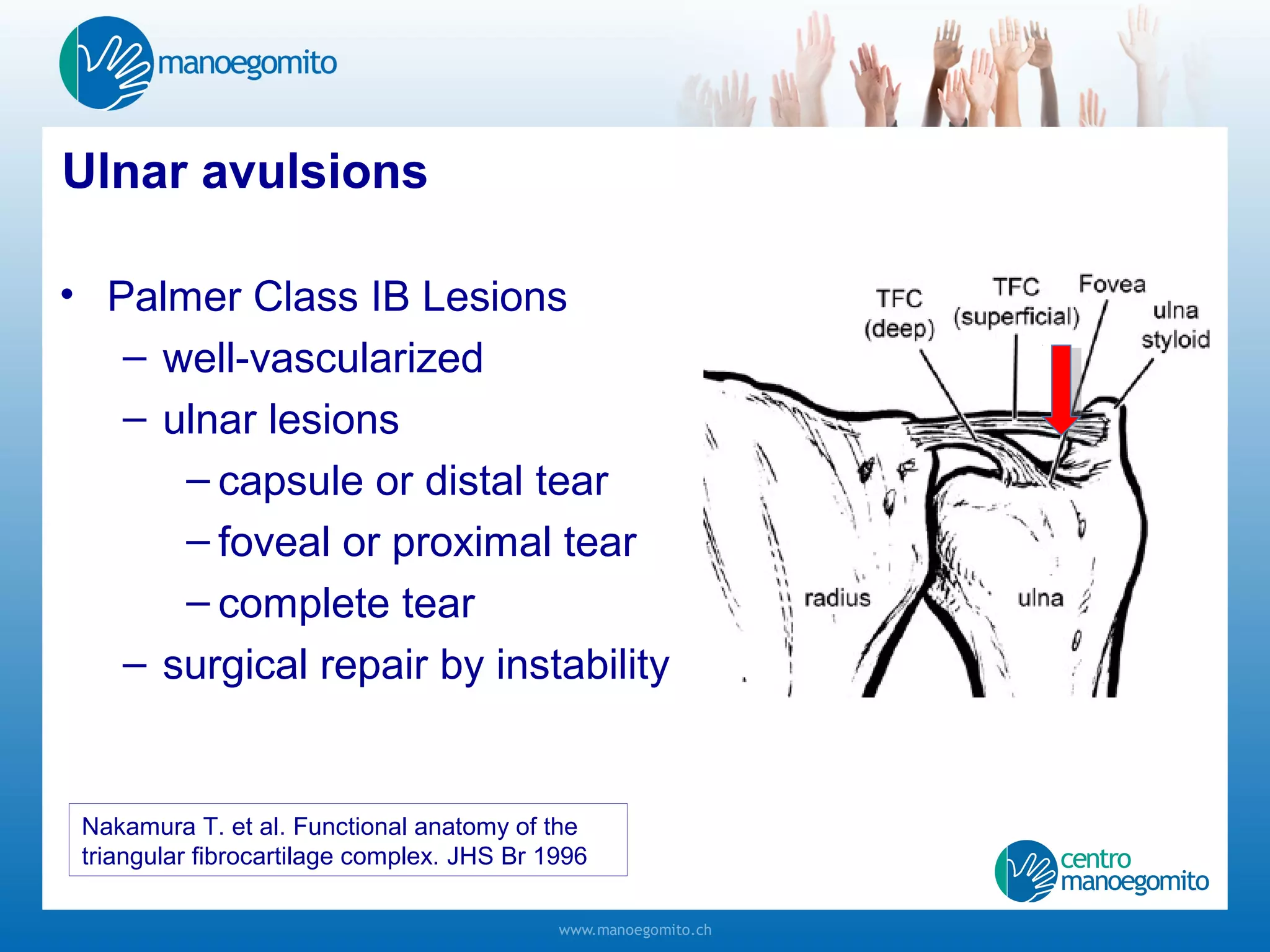 Acute Triangular Fibrocartilage Complex Injuries: Treatment & Management | PPT
