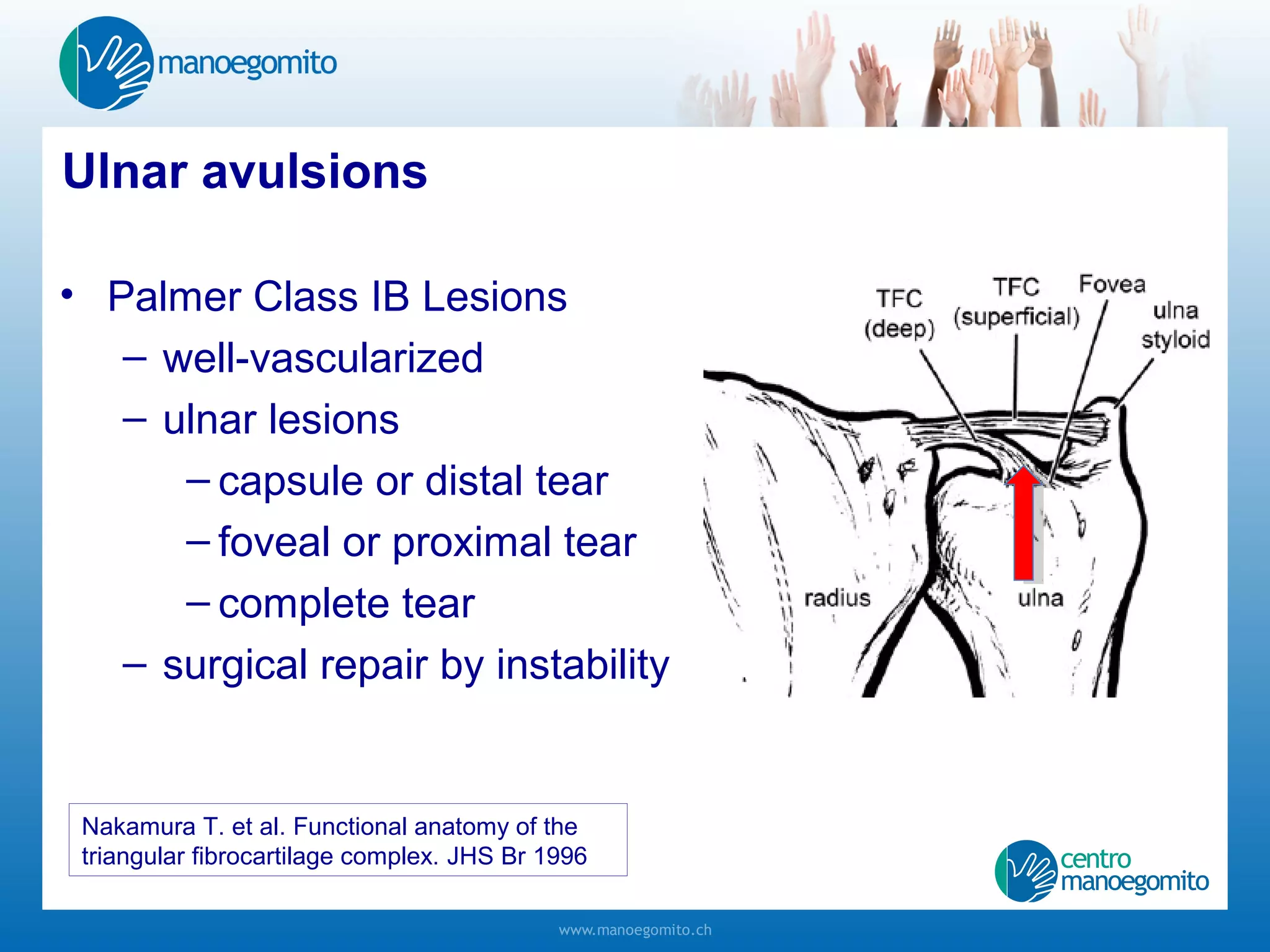 Acute Triangular Fibrocartilage Complex Injuries: Treatment ...