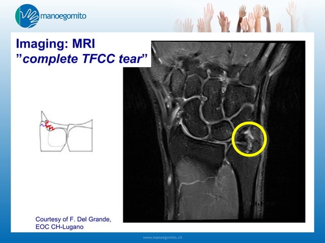 Acute Triangular Fibrocartilage Complex Injuries: Treatment ...