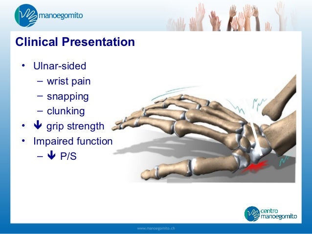 Acute Triangular Fibrocartilage Complex Injuries: Treatment & Managem…