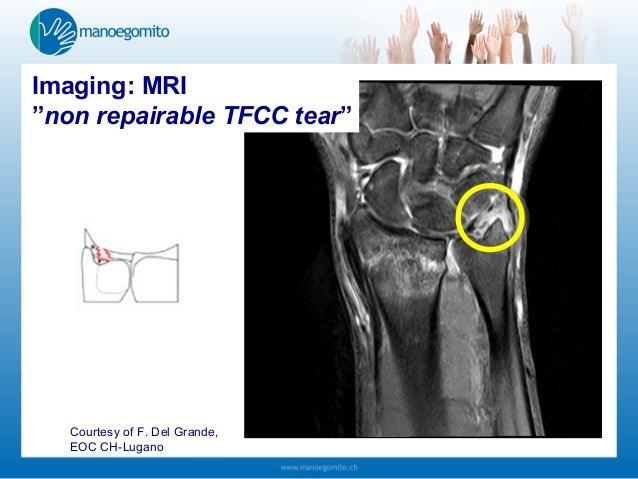 Acute Triangular Fibrocartilage Complex Injuries: Treatment & Managem…