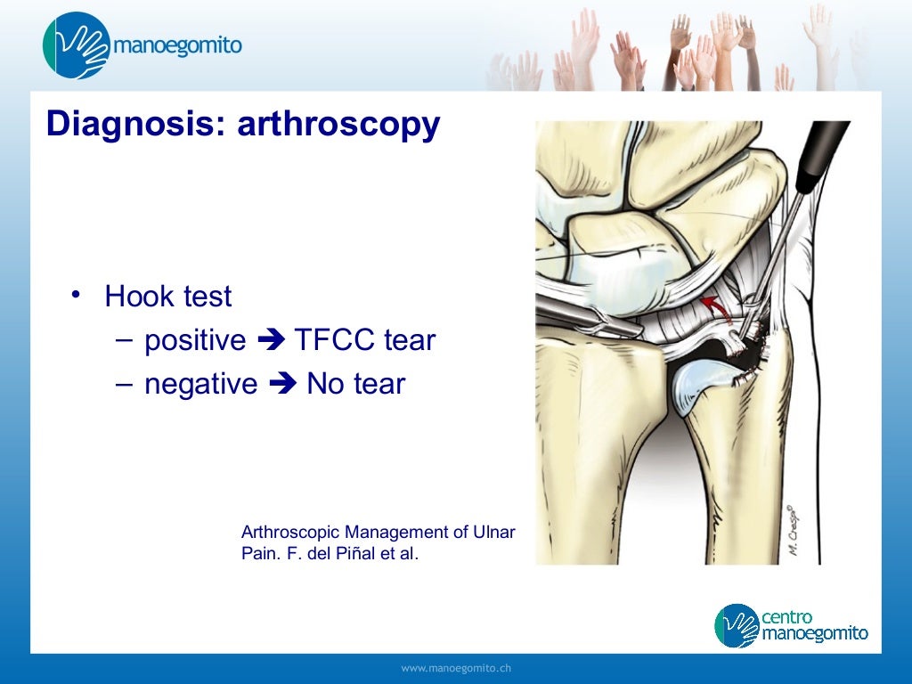 Acute Triangular Fibrocartilage Complex Injuries: Treatment & Managem…