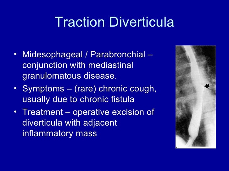 Traction Diverticulum Large Symptomatic Gastric Diverticula: Two Case