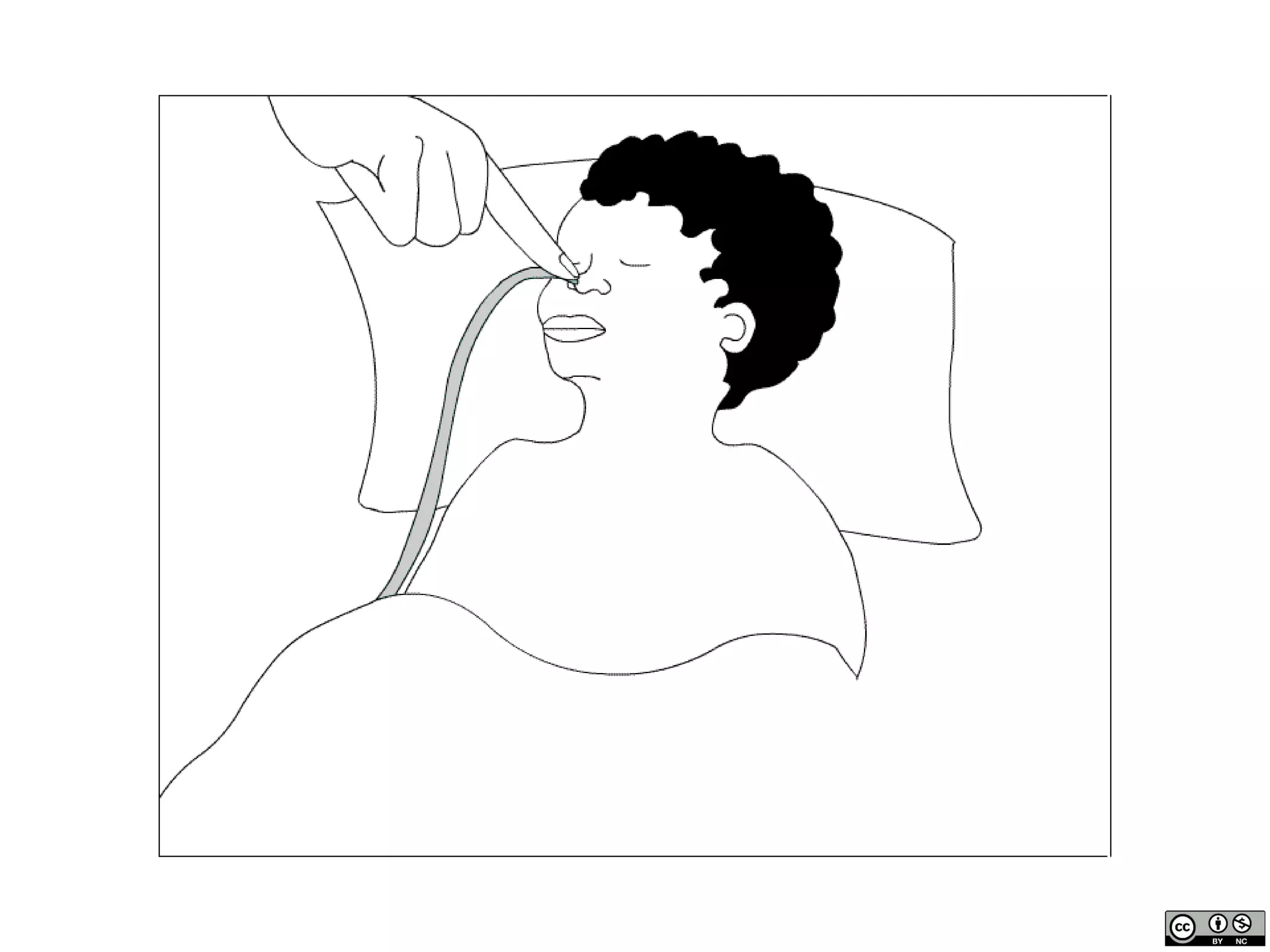 Gastric Lavage Procedure Animation | PPT