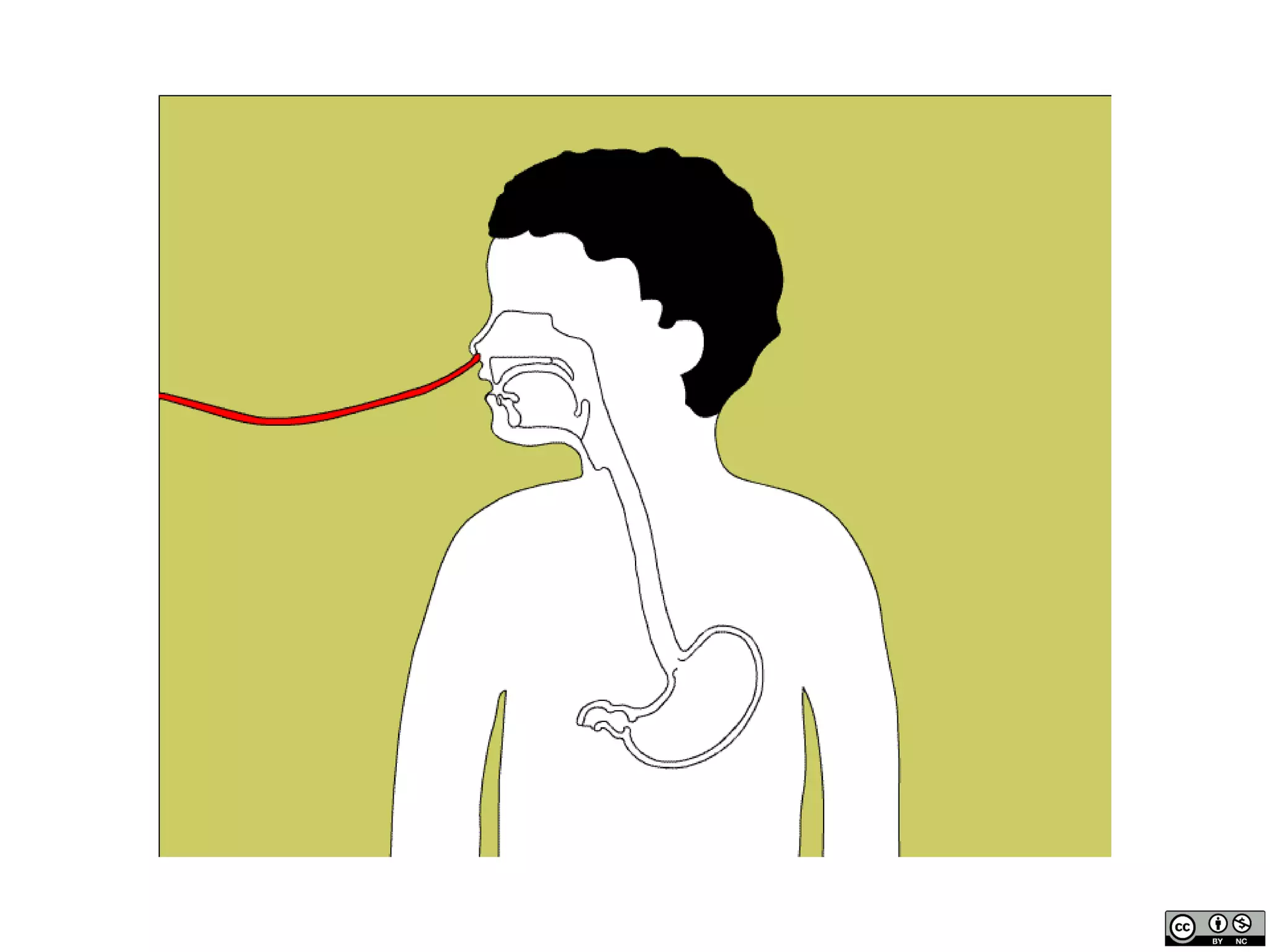 Gastric Lavage Procedure Animation | PPT