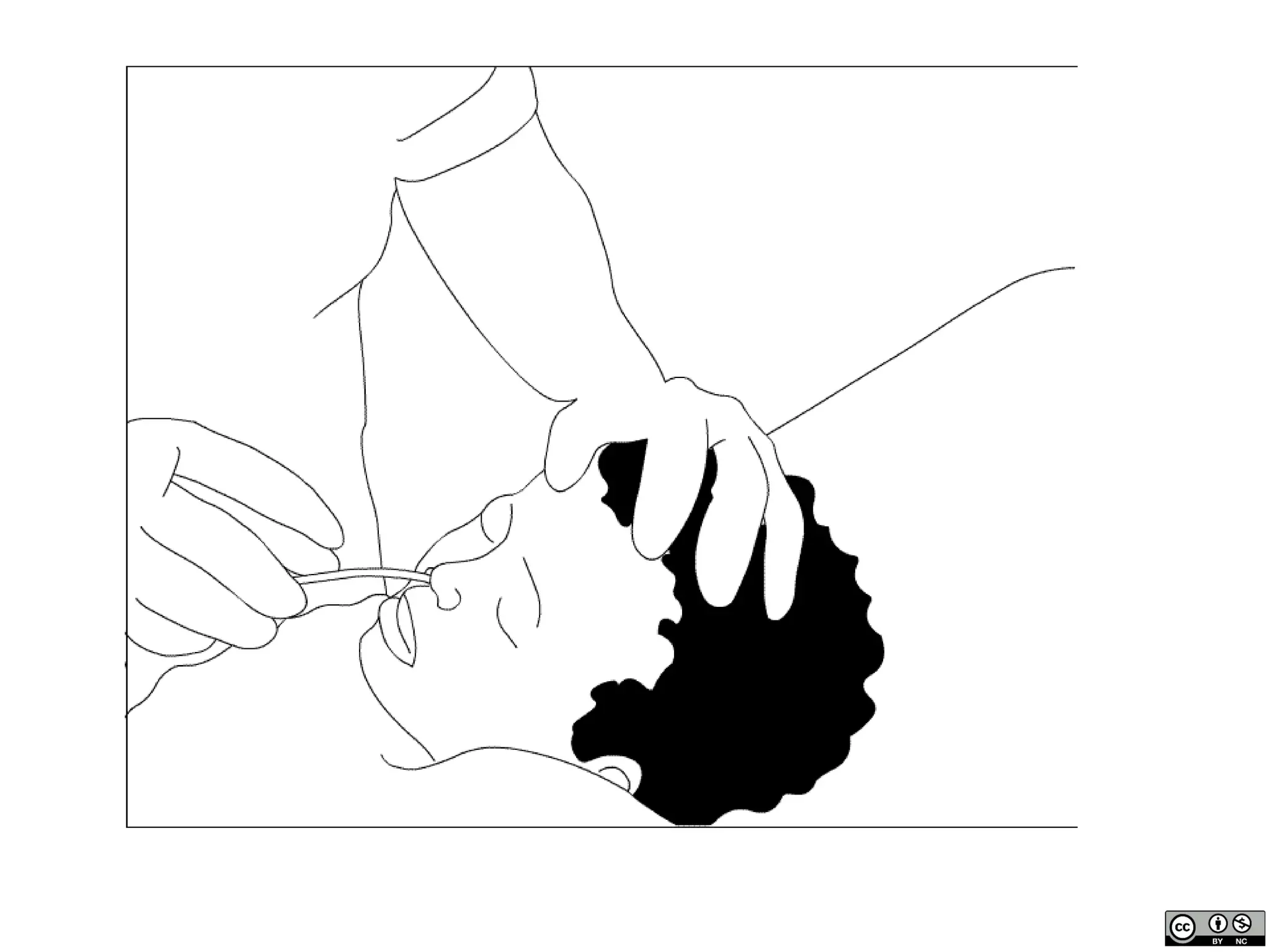 Gastric Lavage Procedure Animation | PPT