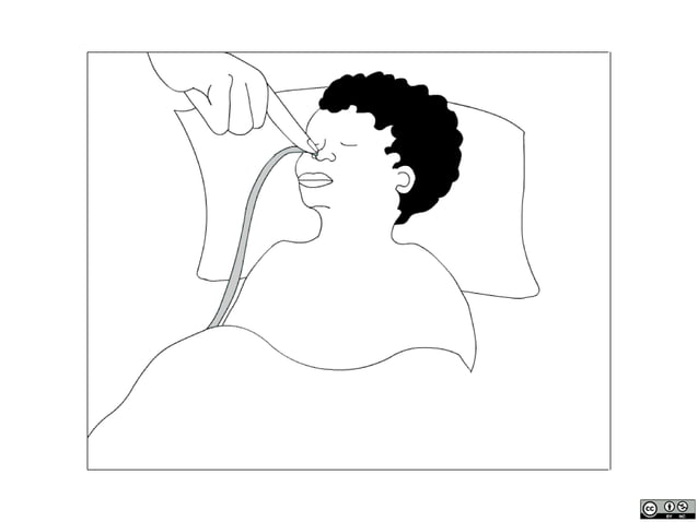 Gastric Lavage Procedure Animation | PPT