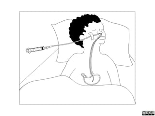 Gastric Lavage Procedure Animation | PPT