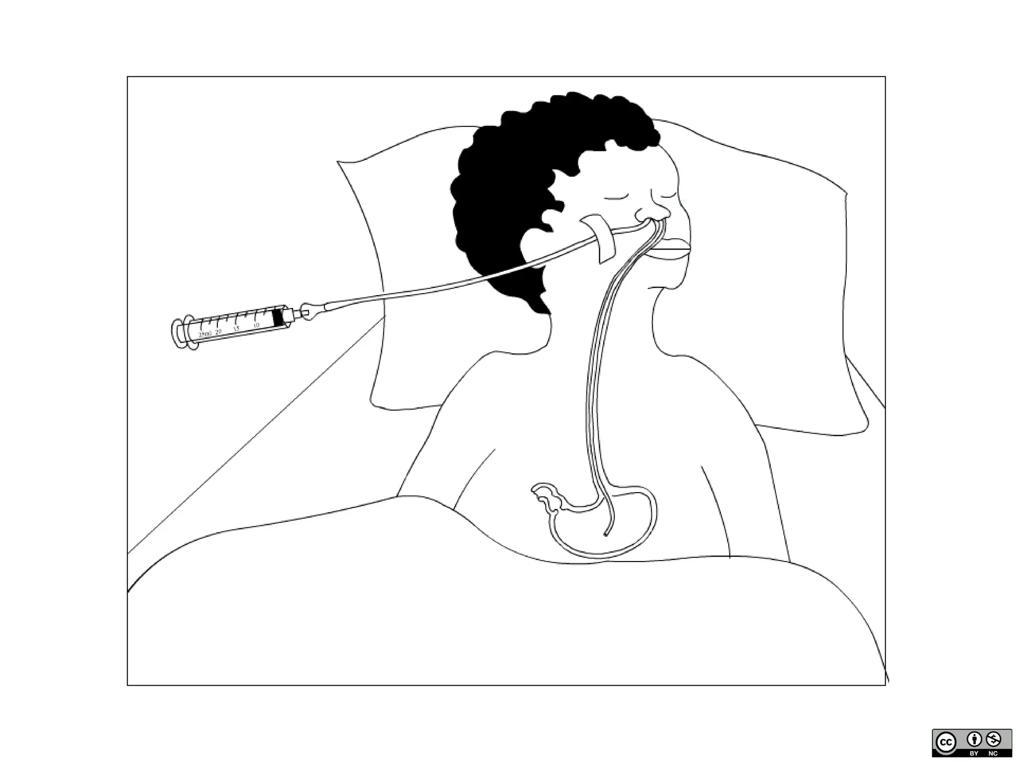 Gastric Lavage Procedure Animation | PPT