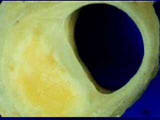 Positive remodeling slides for ralph | PPT | Heart and Cardiovascular ...