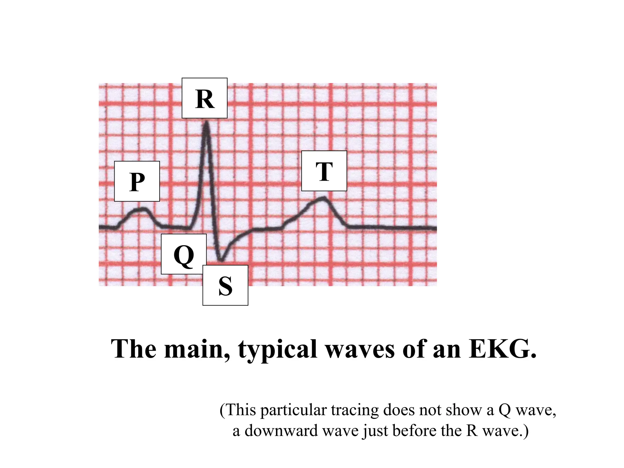 A brief introduction to the standard 12-lead ECG (EKG) | PPT