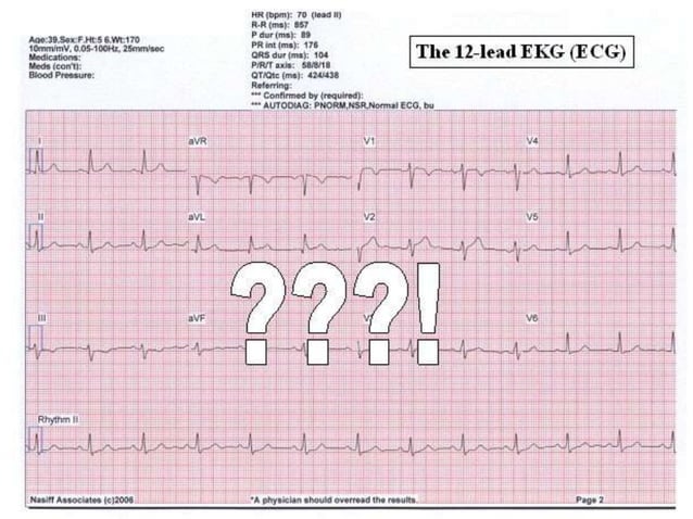 A brief introduction to the standard 12-lead ECG (EKG) | PPT