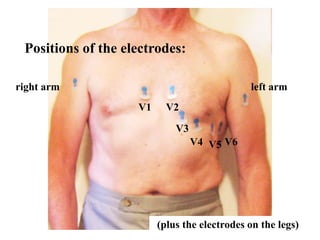 A brief introduction to the standard 12-lead ECG (EKG) | PPT