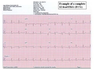 A brief introduction to the standard 12-lead ECG (EKG) | PPT