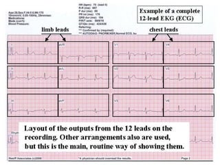 A brief introduction to the standard 12-lead ECG (EKG) | PPT