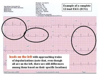 A brief introduction to the standard 12-lead ECG (EKG) | PPT