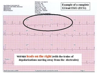 A brief introduction to the standard 12-lead ECG (EKG) | PPT