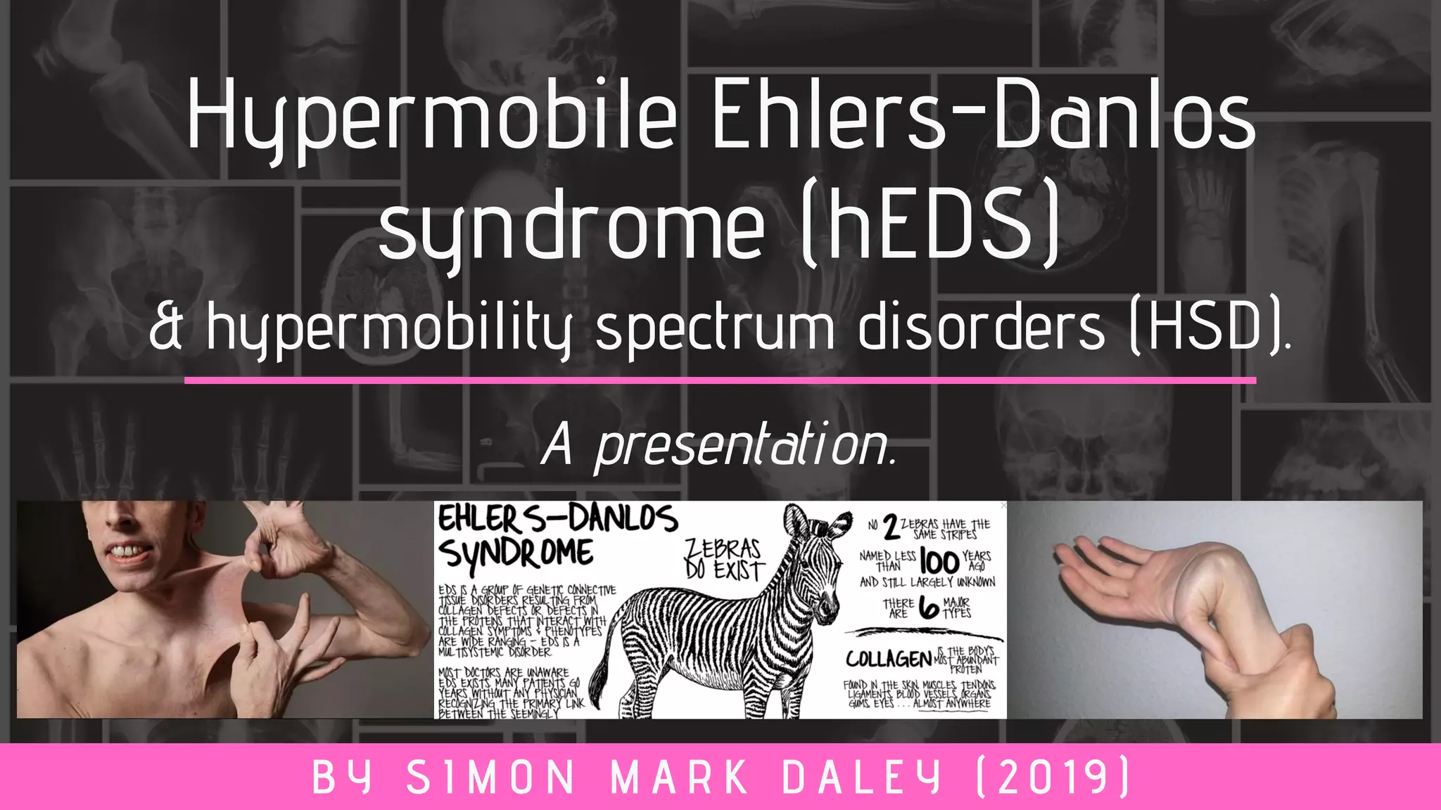 Hypermobile Ehlers-Danlos Syndrome & hypermobility spectrum disorders - A presentation | PDF