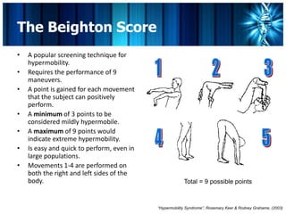 Ehlers-Danlos Syndrome & Hypermobility | PPTX