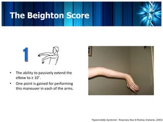 Ehlers-Danlos Syndrome & Hypermobility | PPTX