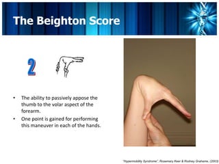 Ehlers-Danlos Syndrome & Hypermobility | PPTX